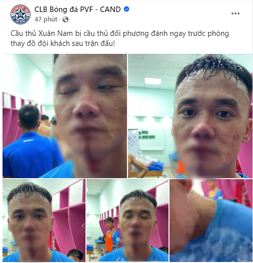 CLB PVF-CAND lên tiếng về vụ tiền đạo Xuân Nam bị đấm chảy máu
